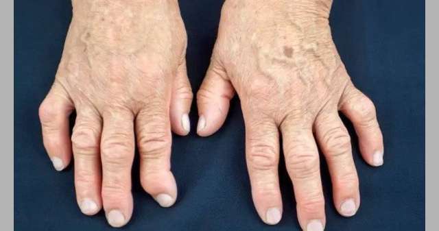 اكتشاف مفاجئ يبشر بعلاج لالتهاب المفاصل الروماتويدي - صحيفة الوطن